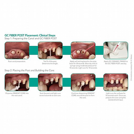 Royal-Dent | רויאל דנט |סט חומר למבנים מחוזק עם הקשייה כפולה GC Gradia ...