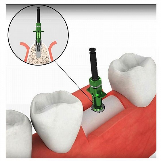 ערכת חילוץ לברגים ושתלים