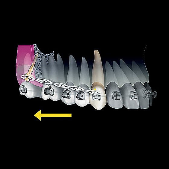 בורג מיני אורתודונטי זיגומטי סטרילי