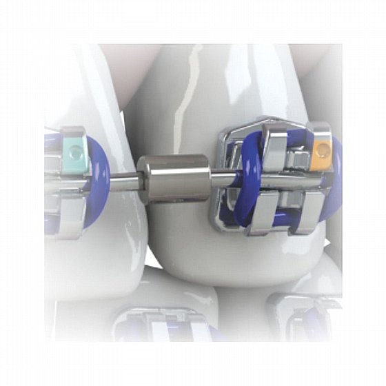 Royal-Dent | רויאל דנט |סטופרים לחוטים אורתודונטיים עד .022 אינץ' 10יח ...